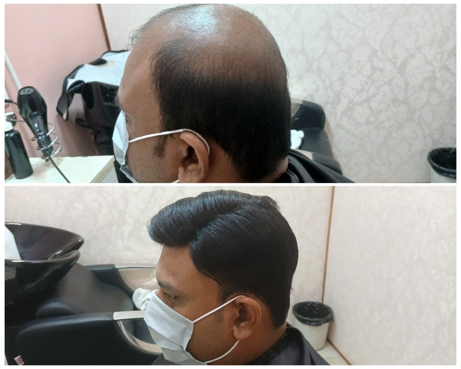 Hair Patch Maintenance Tips for Long-Lasting Results - Advance Clinic