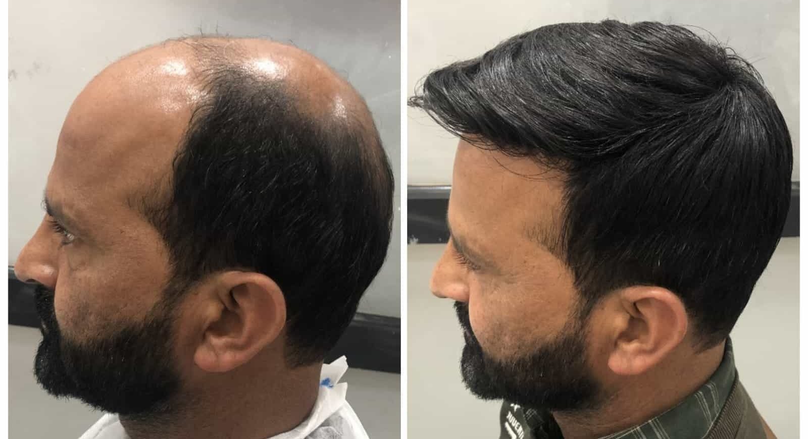 5 Signs That Say It’s Time To Replace Your Hair Patch - Advance Clinic