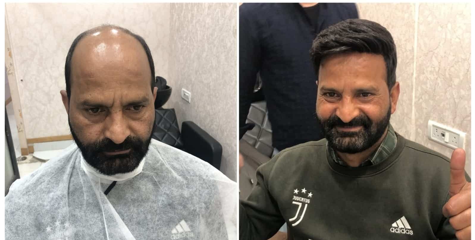 Natural-Looking Hair Patch for Men in Noida, Delhi, Chandigarh & Agra ...