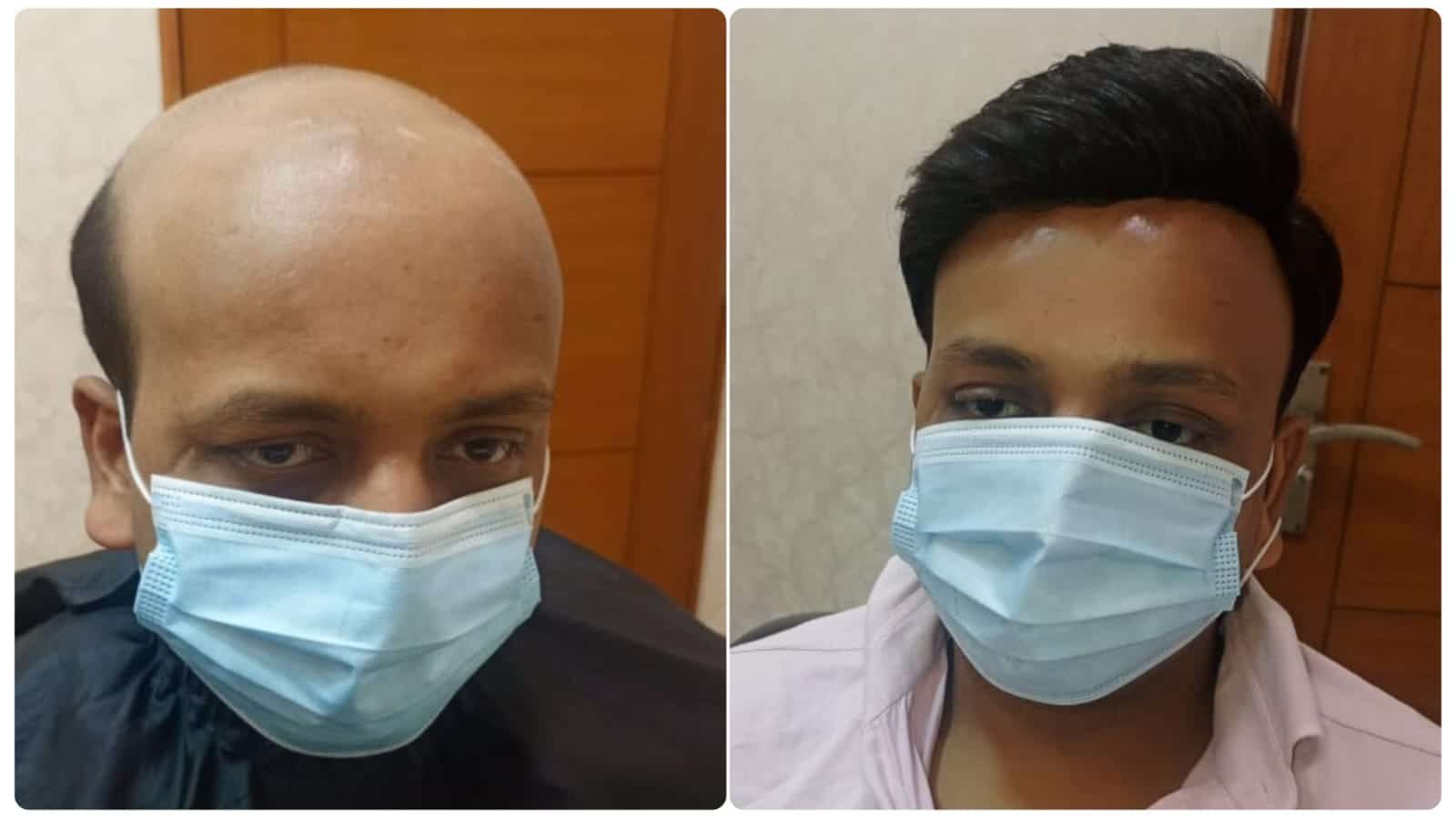 How to Avoid an Itchy Scalp While Wearing a Hair Patch - Advance Clinic